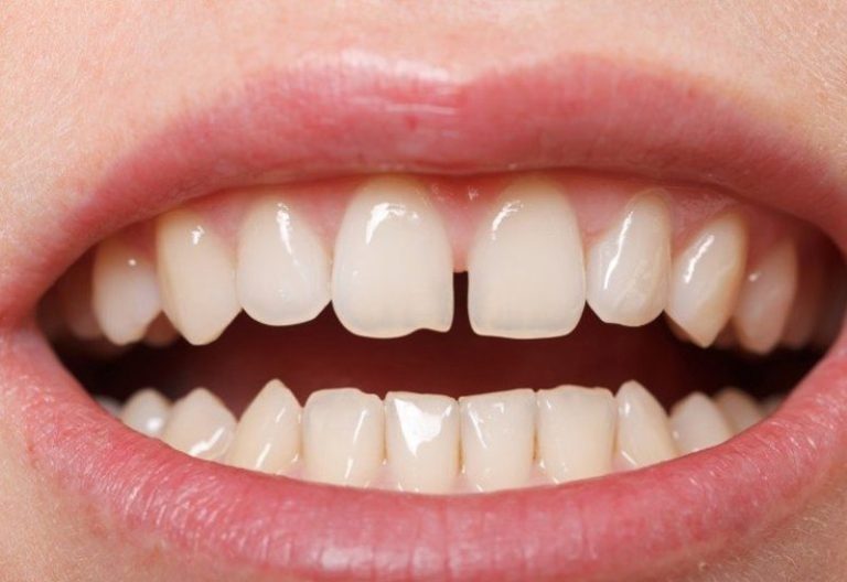 Bọc Răng Sứ Cho Răng Thưa Và Lưu Ý Cần Biết Trước Khi Thực Hiện