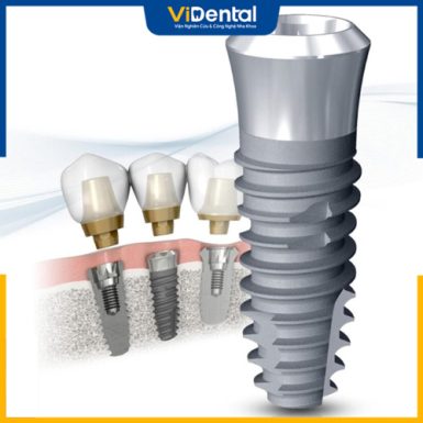 Trụ Implant Dentium Hàn Quốc: Đặc Điểm, Tính Năng Và Chi Phí