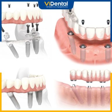 Trụ Implant Dentium Mỹ: Tính Năng Vượt Trội Và Bảng Giá Chi Tiết