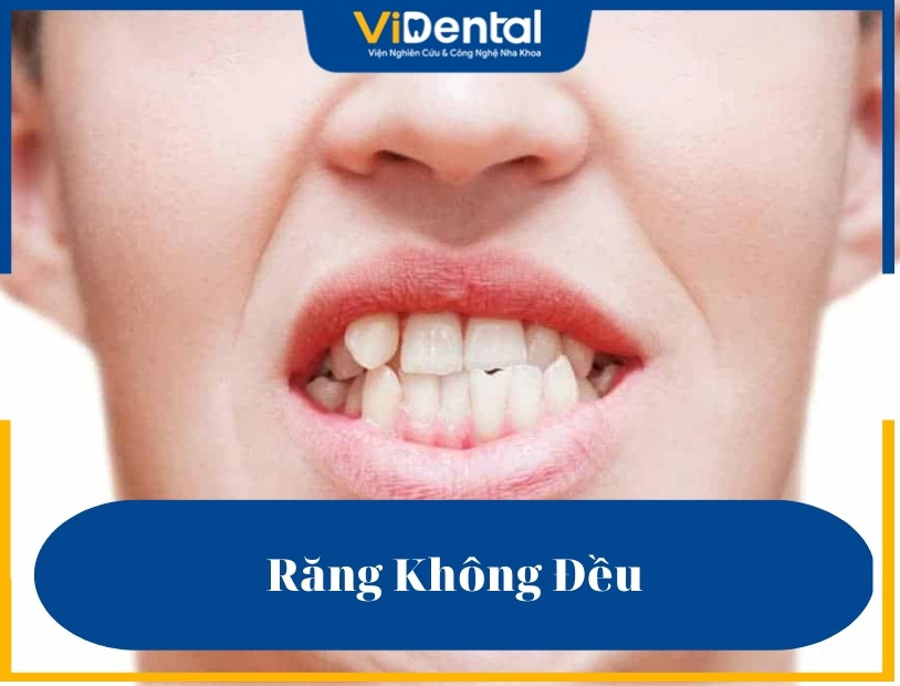 Răng Không Đều: Nguyên Nhân, Hậu Quả Và Phương Pháp Khắc Phục