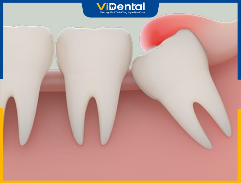 Sưng Nướu Răng Khôn: Nguyên Nhân, Cách Điều Trị Và Một Số Lưu Ý