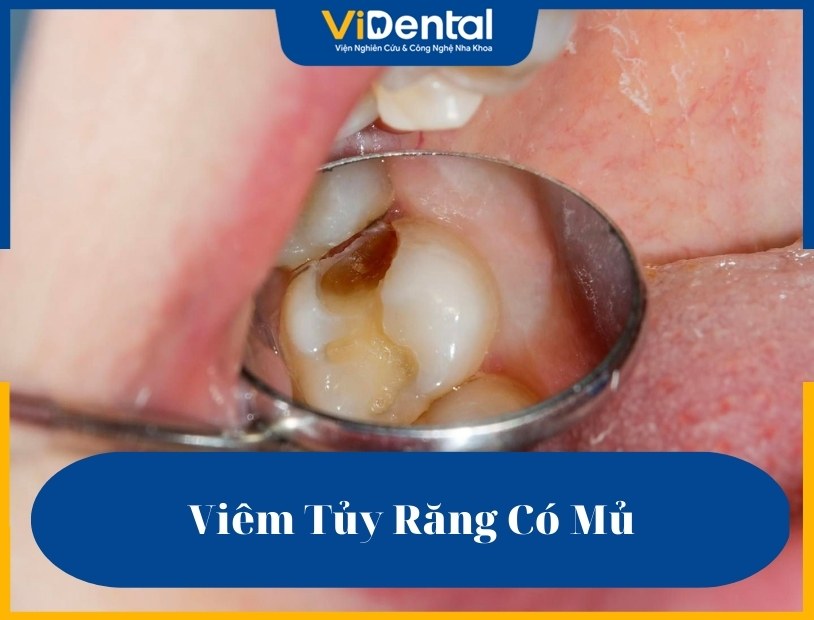 Viêm Tủy Răng Có Mủ: Dấu Hiệu, Nguyên Nhân Và Biện Pháp Xử Lý
