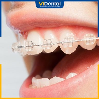 Mắc Cài Damon Có Tốt Không? Ưu Nhược Điểm Và Chi Phí