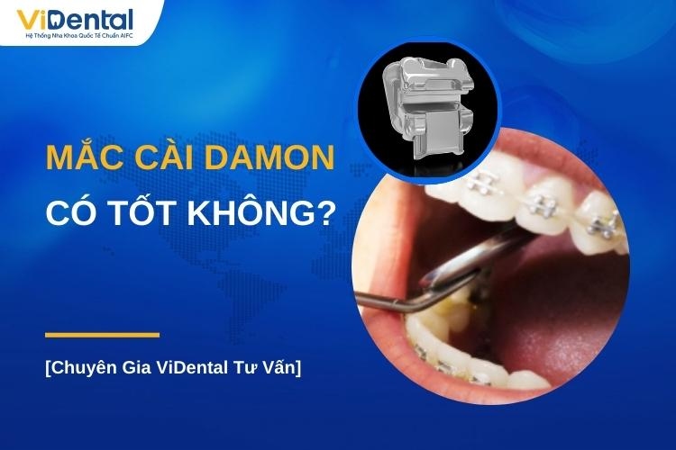 Mắc Cài Damon Có Tốt Không? Ưu Nhược Điểm Và Chi Phí