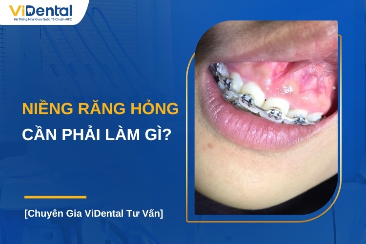 Niềng Răng Hỏng Nguyên Nhân Do Đâu? Dấu Hiệu Và Cách Khắc Phục