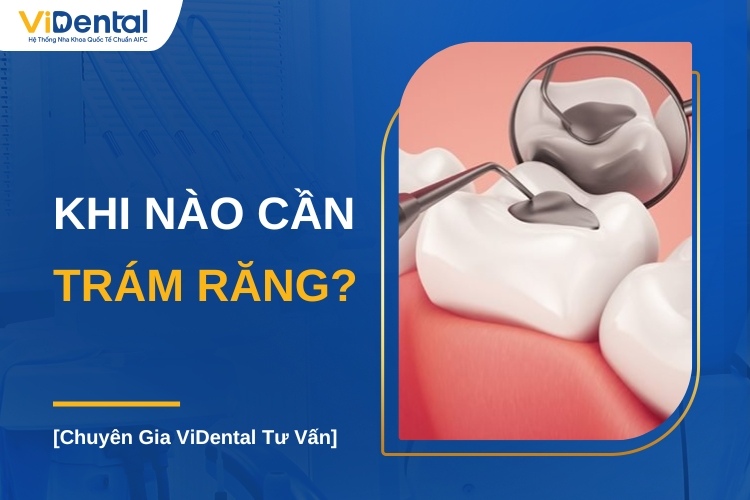 Trám Răng Thẩm Mỹ Là Gì? Có Hiệu Quả Không, Cách Trám Răng Như Thế Nào?