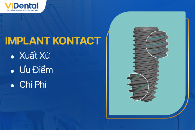 Implant Kontact: Xuất Xứ, Ưu Điểm, Chi Phí Cập Nhật Mới Nhất