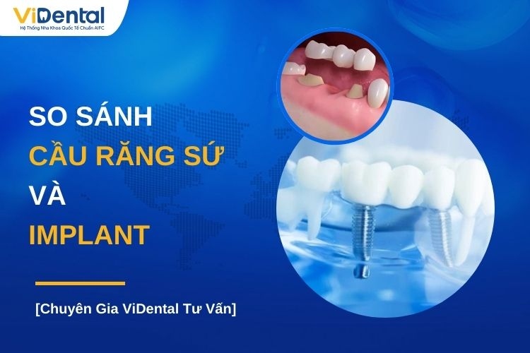 Làm Cầu Răng Sứ Và Implant Giải Pháp Nào Hiệu Quả Hơn?