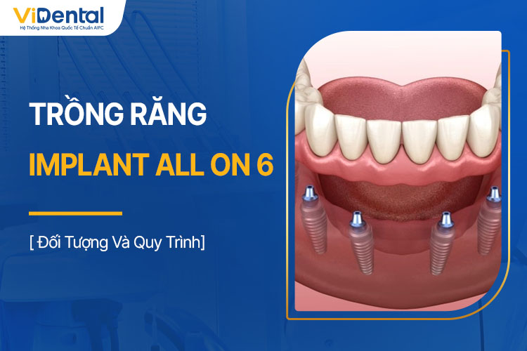 Trồng Răng Implant All On 6 Là Gì? Đối Tượng Và Quy Trình