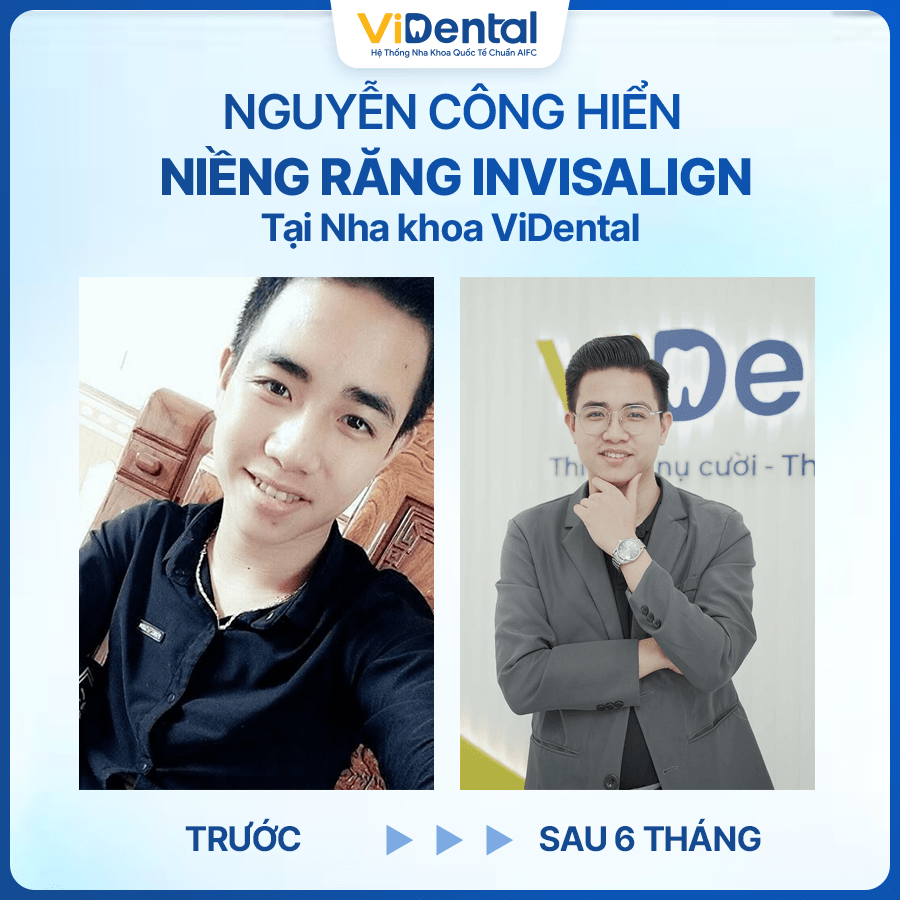 Công Hiển - Niềng Invisalign - Khách hàng tại Nha Khoa ViDental