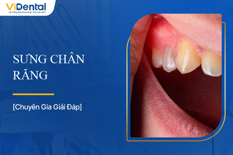 Sưng Chân Răng: Triệu Chứng Nhận Biết, Cách Xử Lý Hiệu Quả