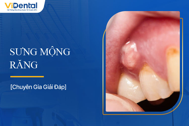 Sưng Mộng Răng: Nguyên Nhân, Triệu Chứng Và Cách Điều Trị